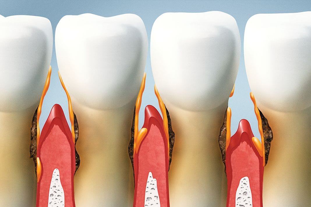 Periodontal Diagnosis: How to Maintain Positive Control of the ...