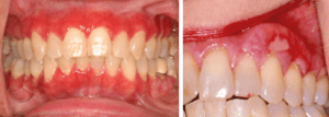 Oral Lichen Planus: Treatment & Management - Today's RDH