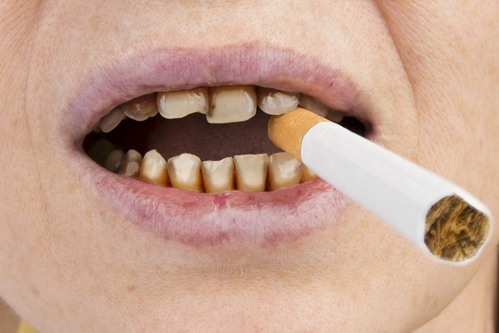 Study Shows Smoking Can Impact Dental Pulp’s Ability to Fight Bacteria ...