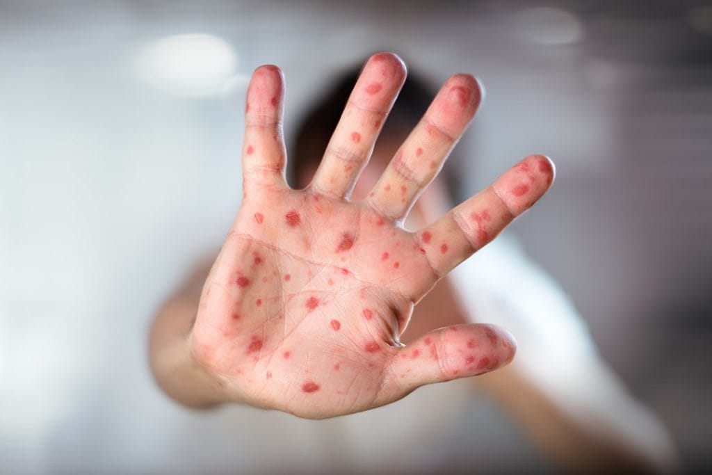 Measles: How Dentistry Can Help Slow Outbreak Through Diagnosis - Today ...