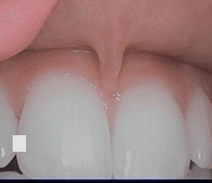 Frenums: Checking for Frenum Abnormalities During Oral Hygiene Exams ...
