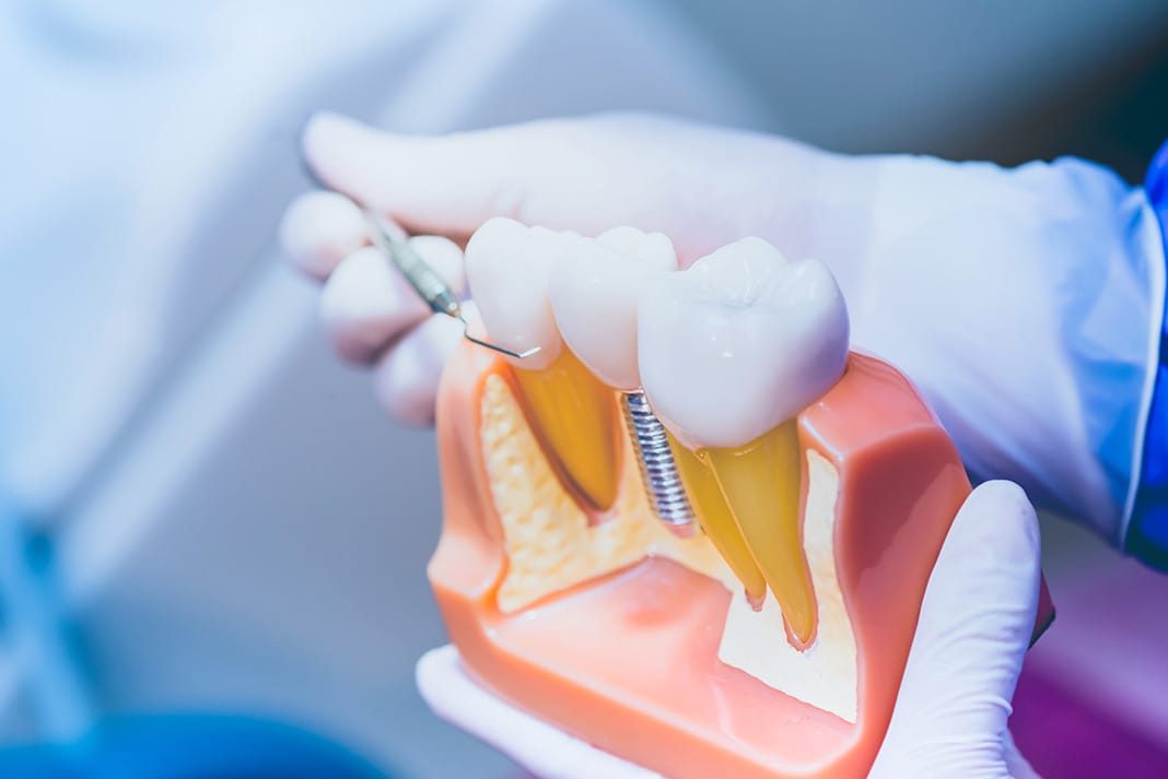 Peri-implant Diseases: The Hygienist's Role in Preserving Implant ...
