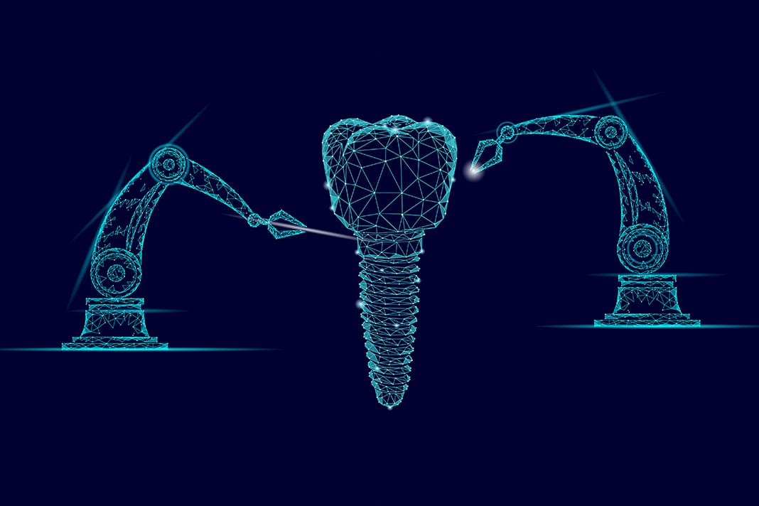 Researchers Build a Smart Dental Implant that Resists Bacterial Growth ...
