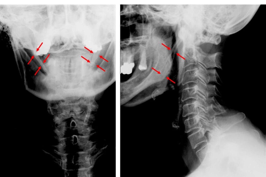 Eagle Syndrome: Dental Professionals can Identify Painful Condition on ...