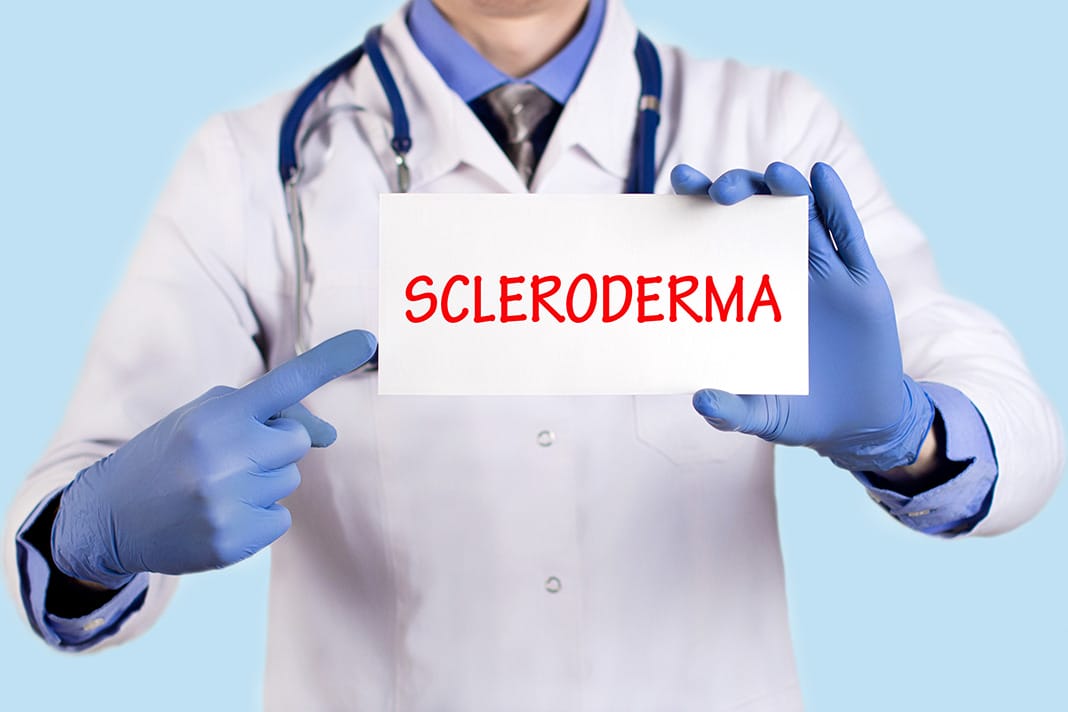 Scleroderma: How Dental Hygienists Can Approach Oral Symptoms - Today's RDH