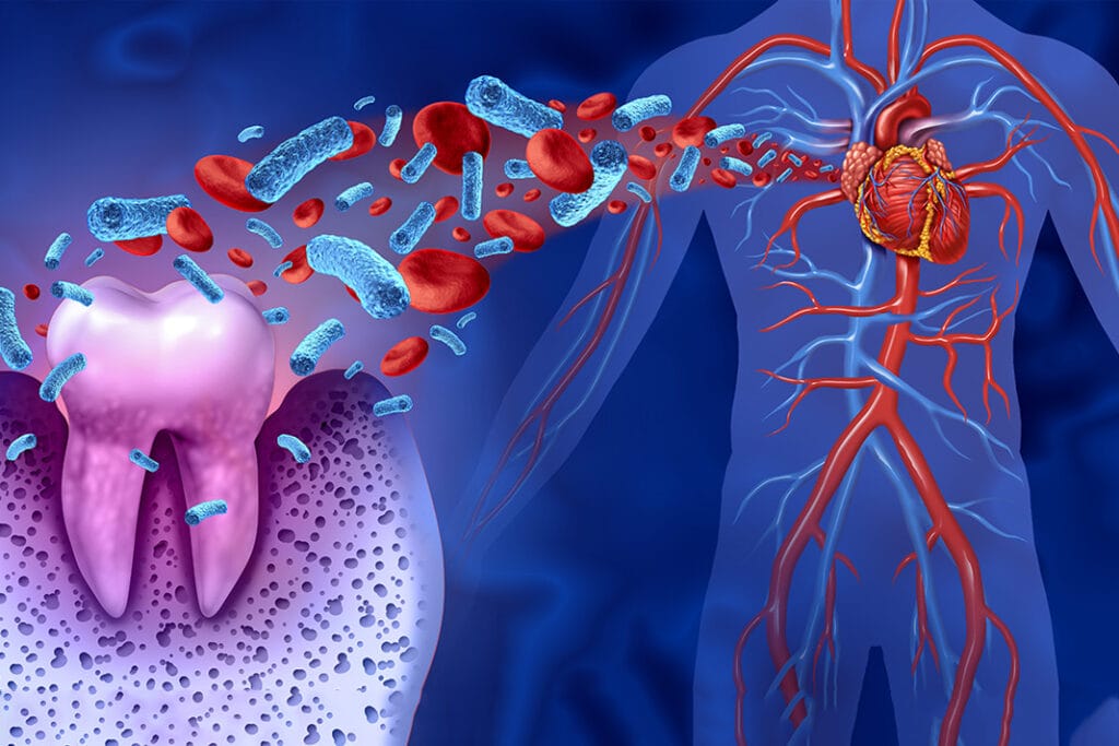More Research Showing Relationship Between Periodontitis ...