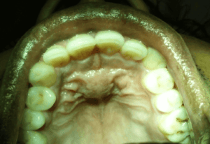 Oral Pathology: Distinguishing Cysts From Abscesses - Today's RDH