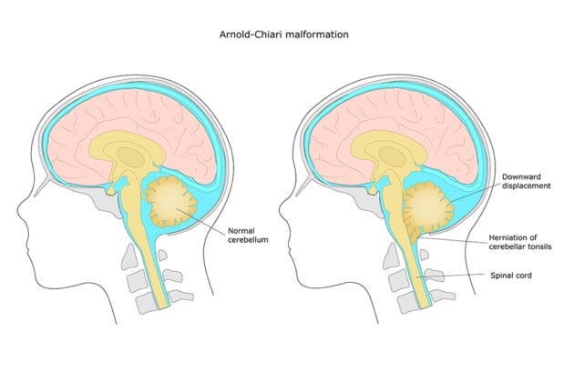 Chiari Malformation: Identifying Potential Oral Health Symptoms in ...
