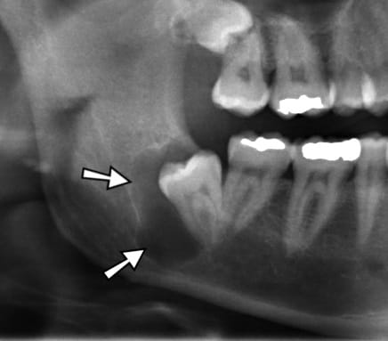Oral Pathology: Distinguishing Cysts From Abscesses - Today's RDH