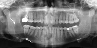 Oral Pathology: Distinguishing Cysts from Abscesses - Today's RDH