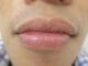 Kiss and Tell: Variations of Normal and Pathology of the Lips - Today's RDH