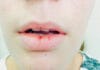 Kiss and Tell: Variations of Normal and Pathology of the Lips - Today's RDH