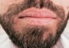 Kiss and Tell: Variations of Normal and Pathology of the Lips - Today's RDH