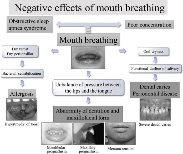 Mouth Taping: Viral Fad or Evidence-Based Treatment for Mouth Breathing ...