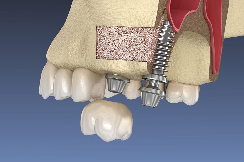 A Hygienists’ Overview of Sinus Augmentation and Its Role in Implant ...