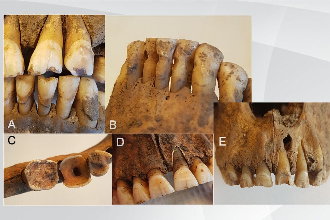 Researchers Find that Viking Age Dentistry Was Probably More ...