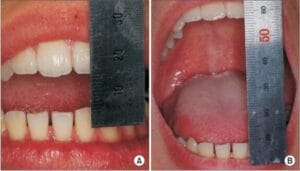 Trismus: A Potential Complication of Administering Local Anesthesia ...