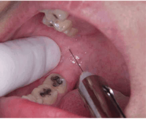 Trismus: A Potential Complication of Administering Local Anesthesia ...