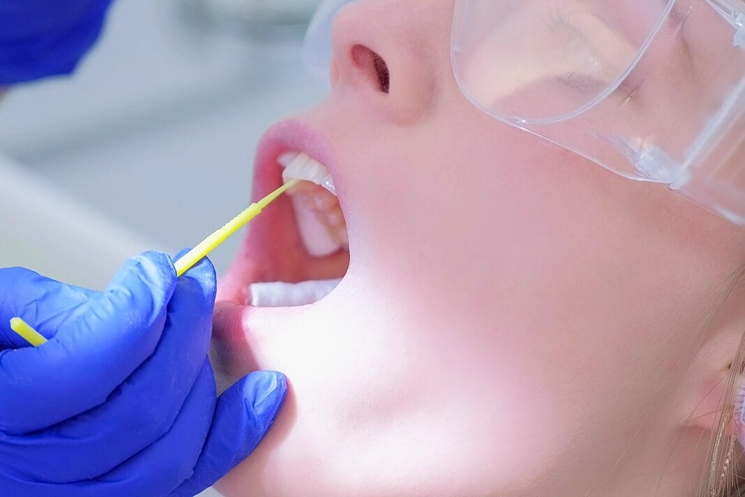 Nano-Hydroxyapatite Varnish: Does Research Support Caries Prevention ...