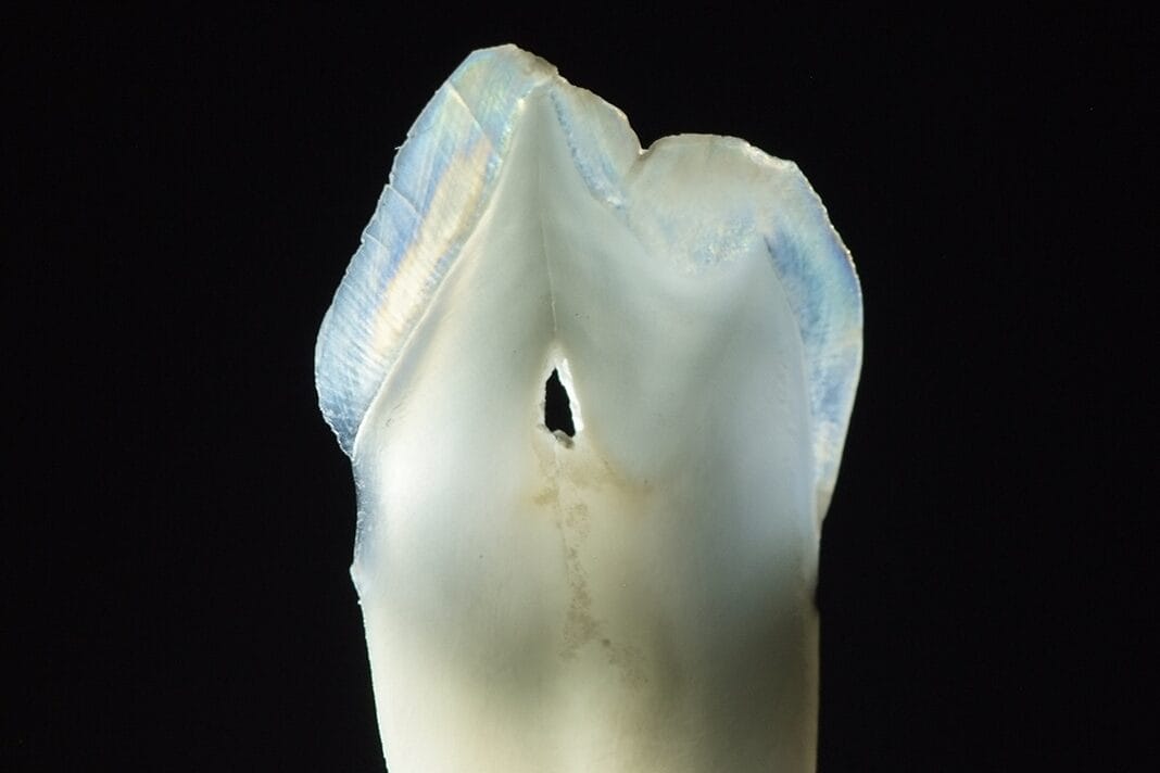 Teeth Stress Lines: How Teeth Are Archives of Our Past - Today's RDH