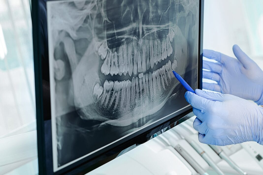 Suction Backflow: How Dental Hygienists Can Prevent Cross-contamination ...