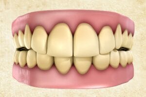 Stain, Stain, Go Away: 8 Causes of Extrinsic Tooth Staining - Today's RDH